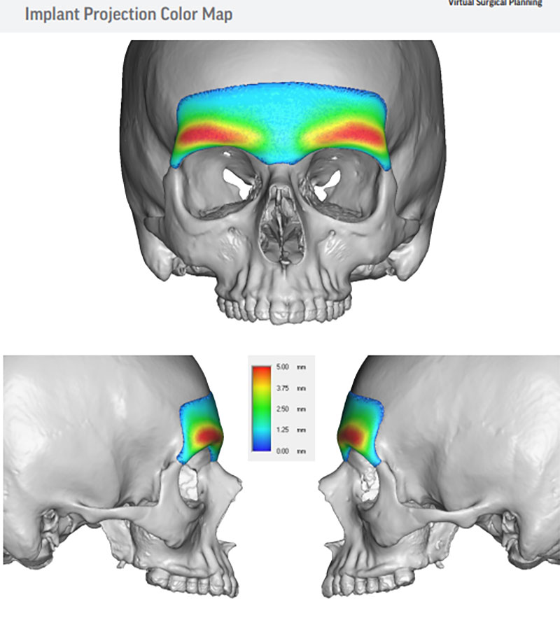 Brow Bone Augmentation Houston | Facial Masculinization | Dr. Rodman