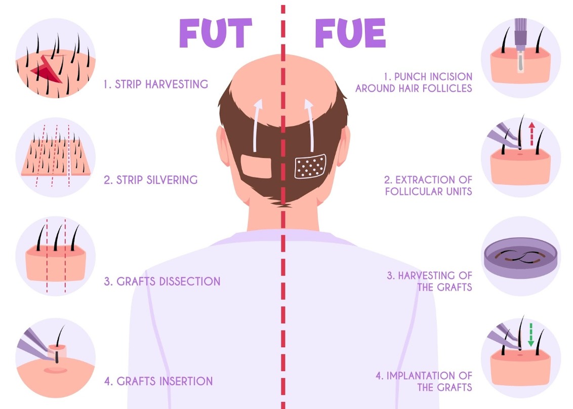 FUE Hair Transplant Houston | Follicular Unit Extraction